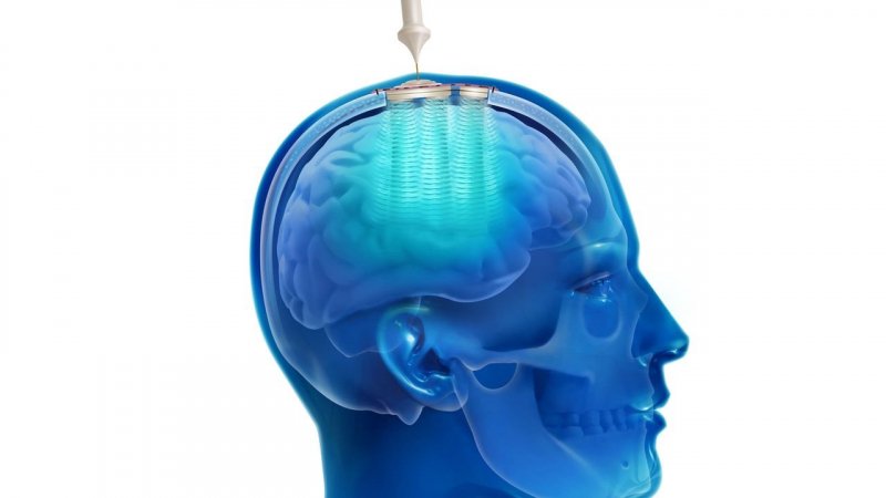 Carthera secures additional €4.5M for innovative medtech to treat brain ...